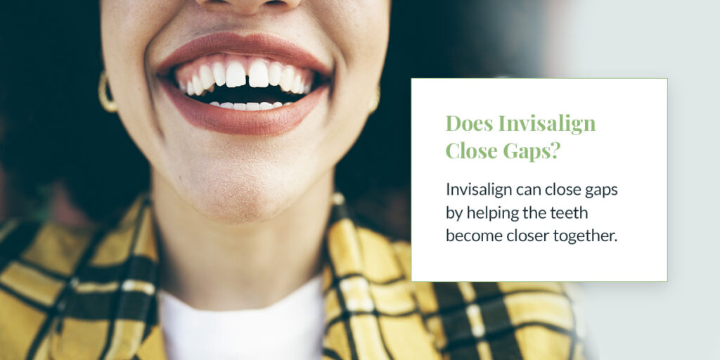 Can Invisalign Fix Bite Alignment? | 172 NYC Dental
